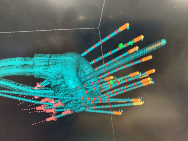 Brachytherapy Advanced Gynaecological Applicator used for first time ...
